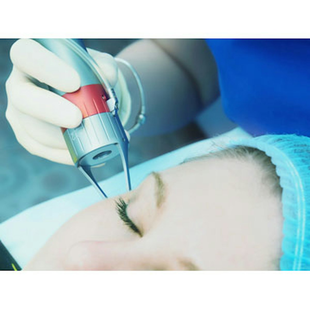 Energy-Based Treatments Safe After PMMA Injections | MedEsthetics