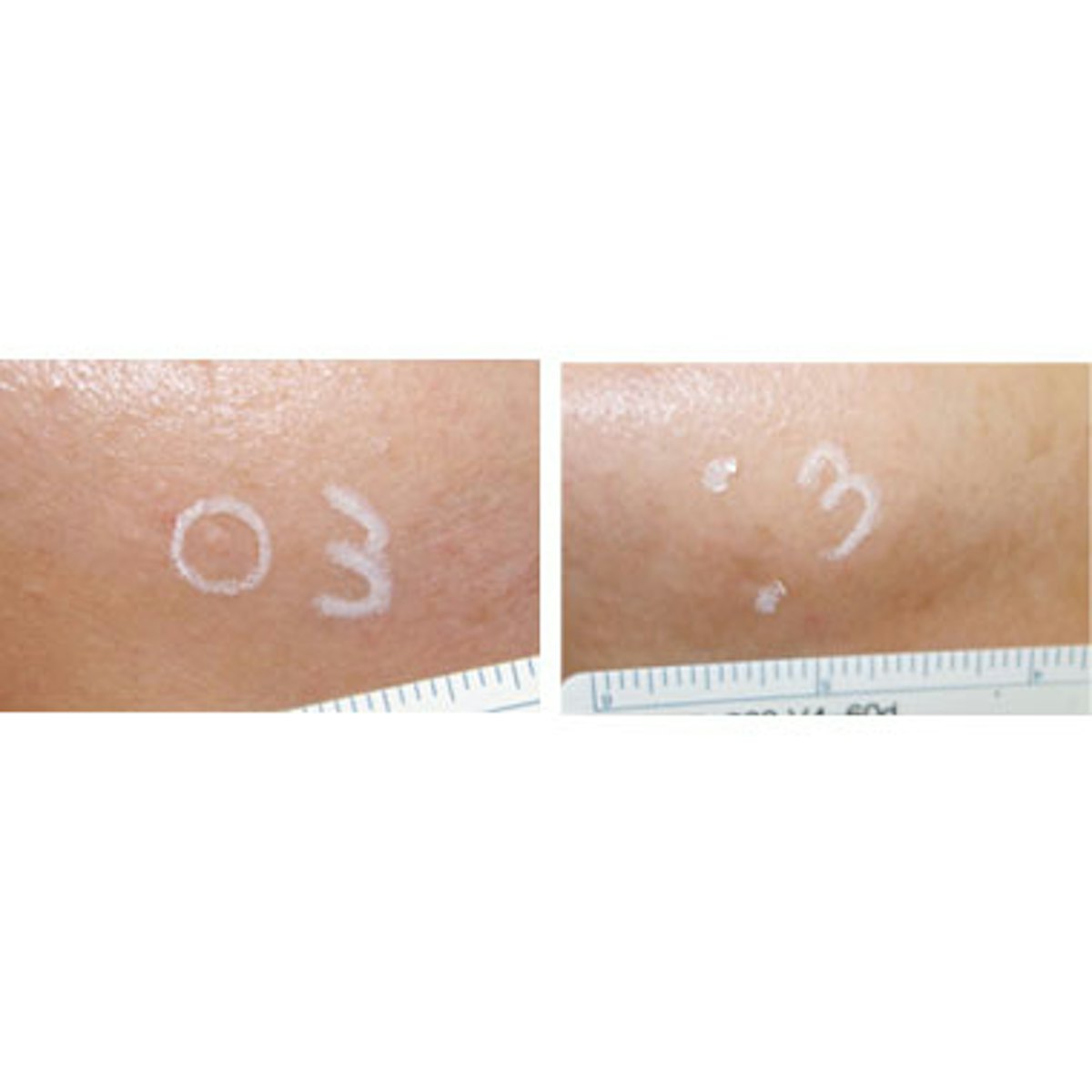 Pulse Biosciences Seeking 510(K) Approval for CellFX Nanopulse ...