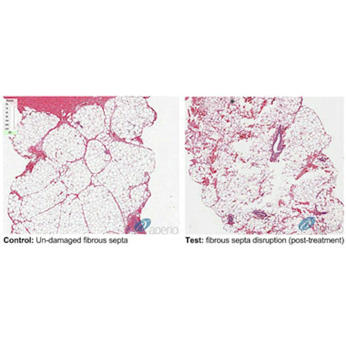 Acoustic Pulse Subcision May Improve Appearance of Cellulite | MedEsthetics