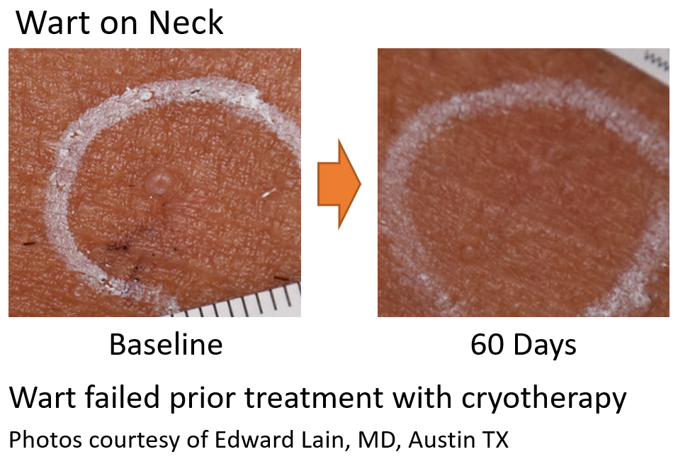 News Article Pulse Biosciences Presents Data On Nps Technology For