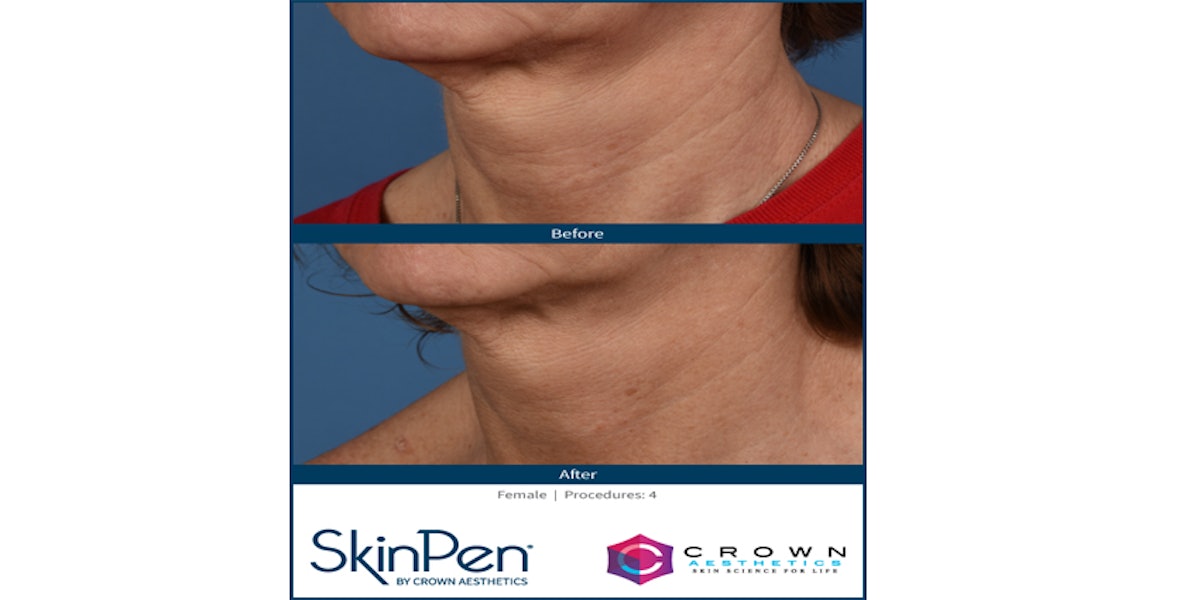 SkinPen Receives FDA Clearance for Neck Rejuvenation | MedEsthetics