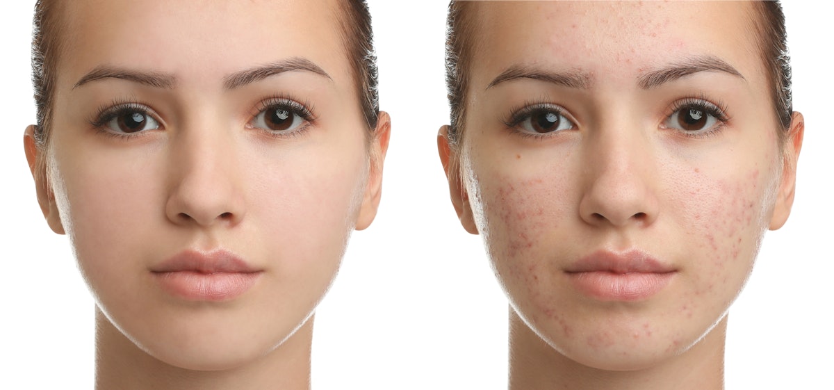 STRATA Skin Sciences Acquires TheraClear Acne System | MedEsthetics