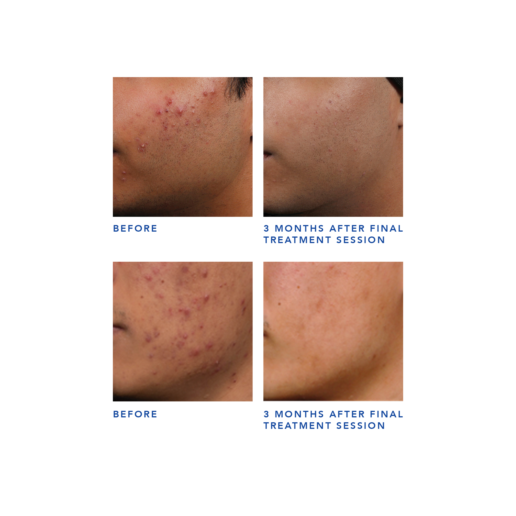 FDA Clears Cutera AviClear 1,726 nm Acne Laser | MedEsthetics