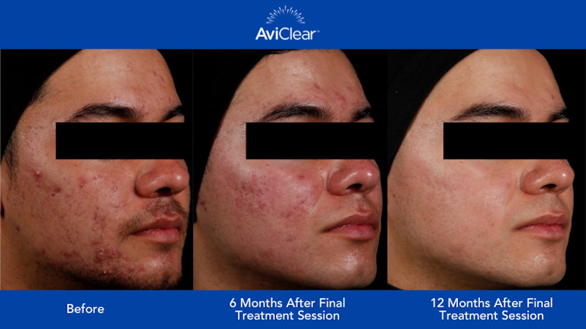 New AviClear by Cutera Data Revels a 92% Improvement in Acne Clearance ...