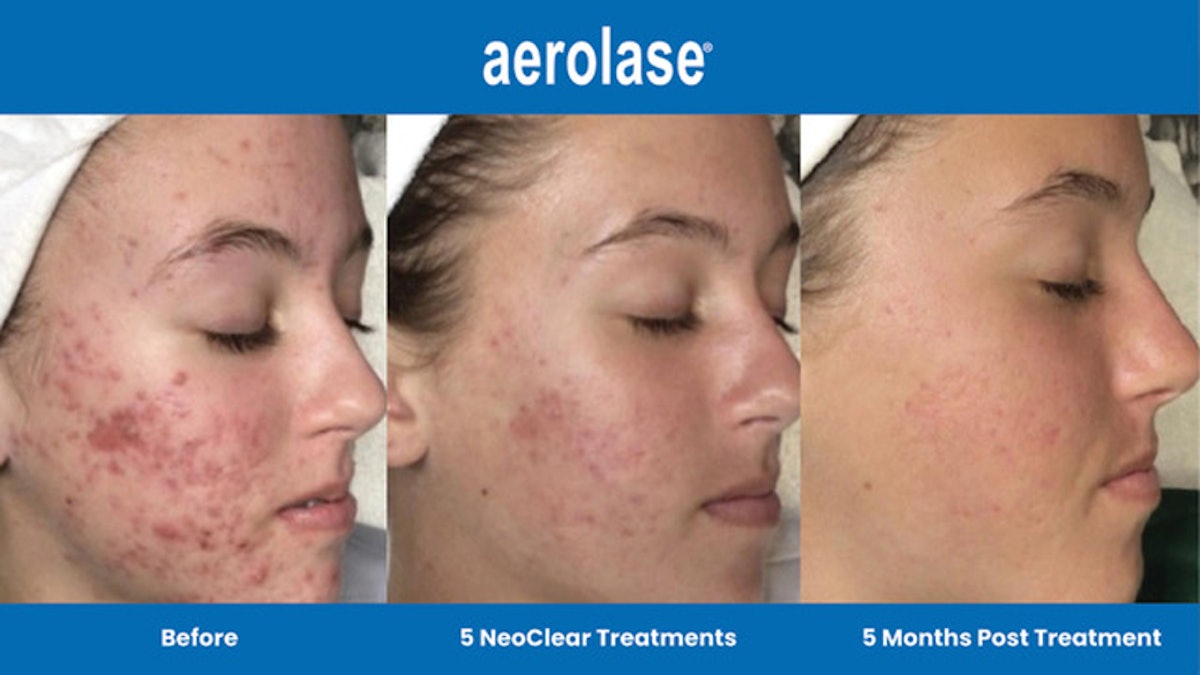 Start Eliminating Acne Today | MedEsthetics