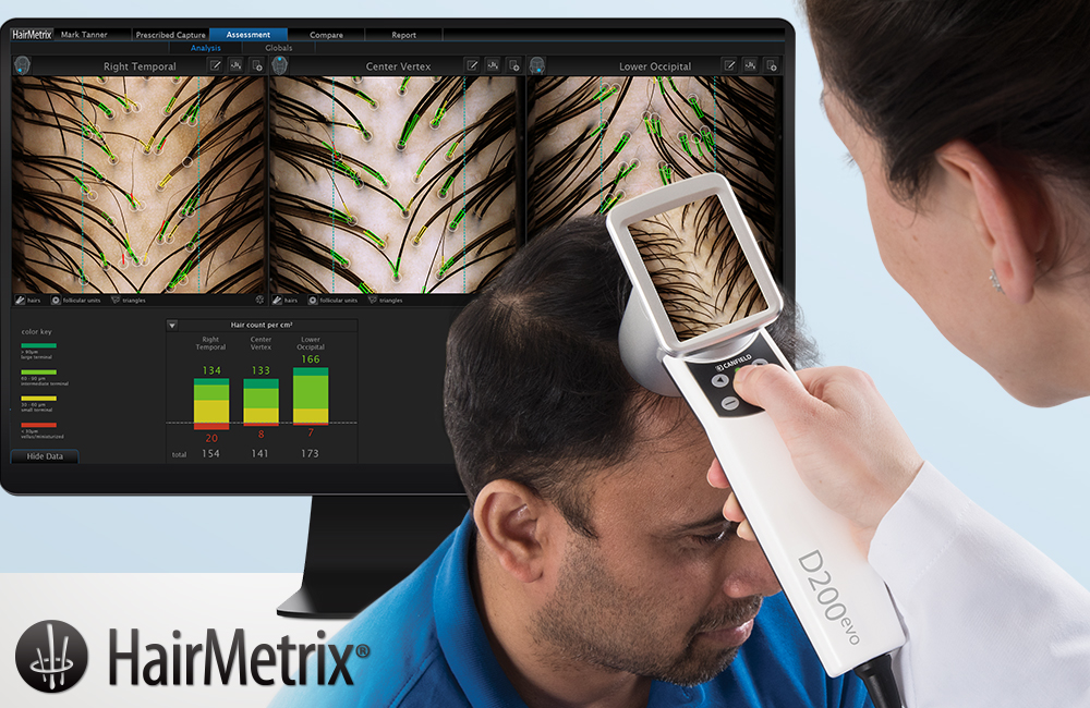 HairMetrix®: The First AI-driven Non-invasive Hair Consultation ...