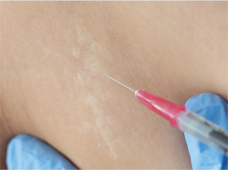 Scar Revision Techniques: Exploring the Latest Treatment Innovations ...